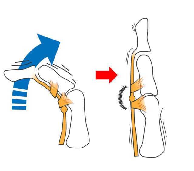 Trigger Finger & Acupuncture: A Natural Treatment & Recovery