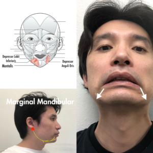 How to Scale Your Bell’s Palsy - hariQ acupuncture & herbs