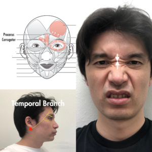 How to Scale Your Bell’s Palsy - hariQ acupuncture & herbs