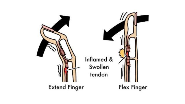 How to Use One Spoon for Trigger Finger - heriQ acupuncture